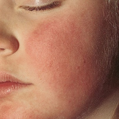 Farmacia 2 Online: Eritema