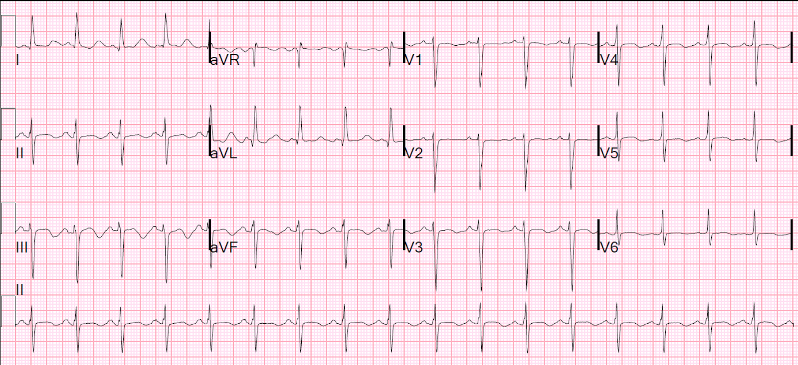 Dr. Smith's ECG Blog: Long QT Syndrome with Continuously Recurrent ...