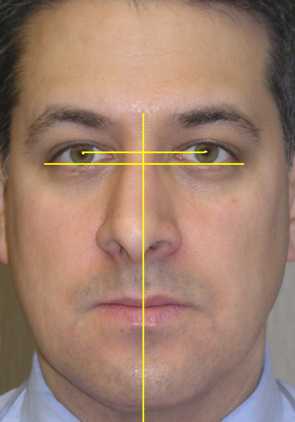 Facial Development Newsletter: THE HOMEOBLOCK™AS A TONGUE RETAINING DEVICE