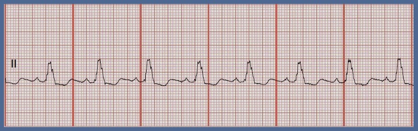 EKG Rhythm Strip Quiz 198