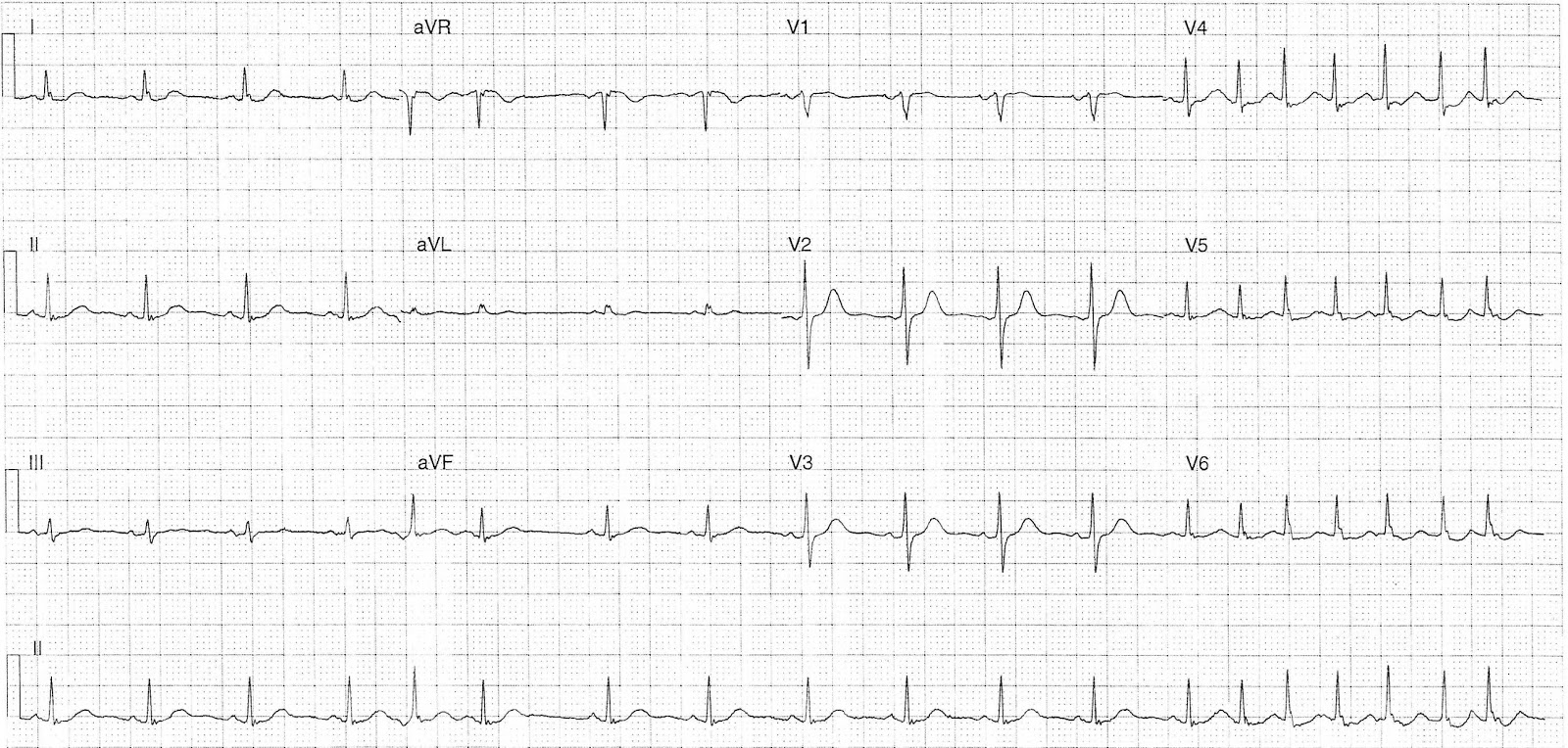 ECG of the Week: ECG of the Week - 3rd October 2016 - Interpretation