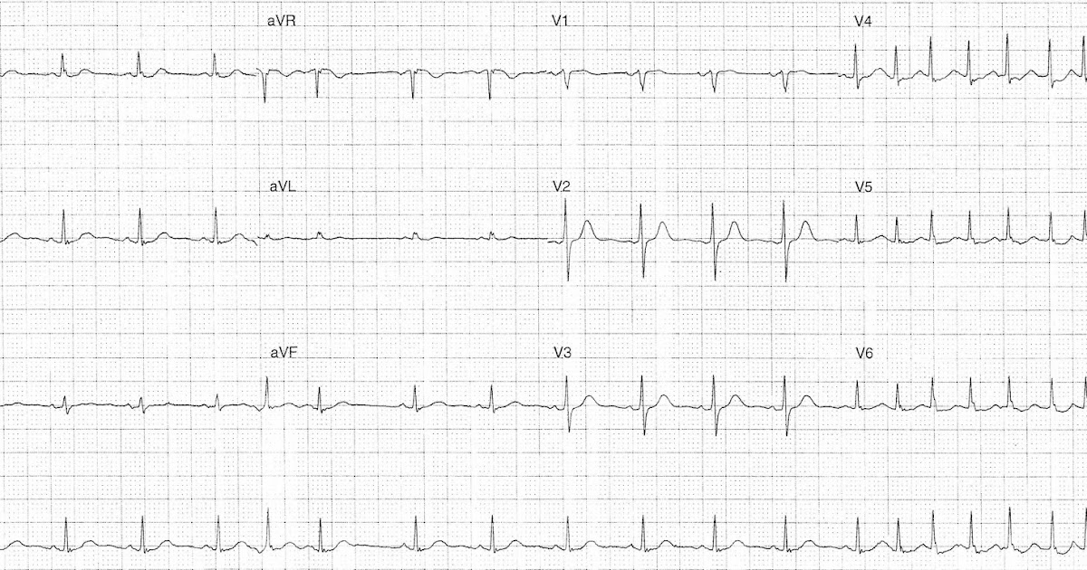 What Does A Normal Ecg Look Like : A normal ekg is one that shows what ...