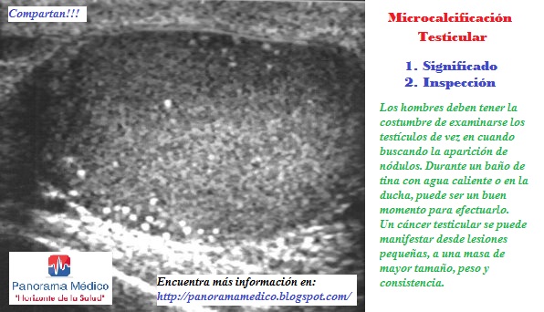 Panorama médico: Microlitiasis Testicular