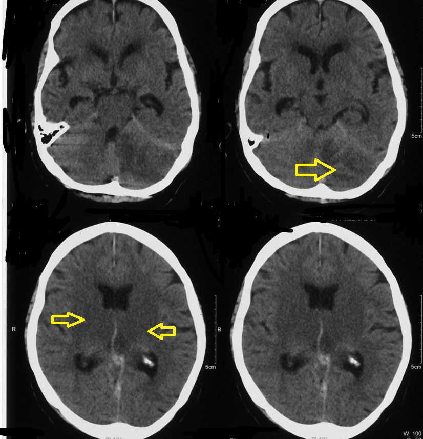 Cerebral venous thrombosis: superficial & deep venous system- Case ...