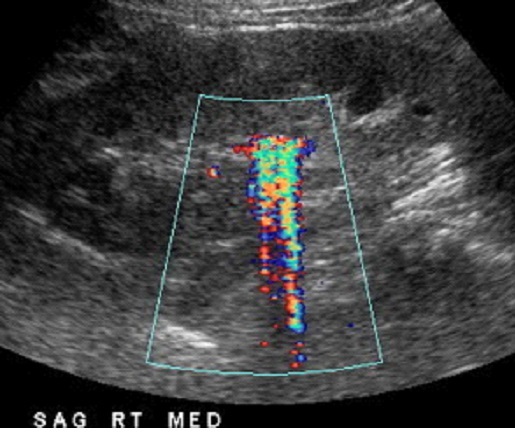 Renal Ultrasound Cases (Adrenal haemorrhage, Perinephric haematoma ...