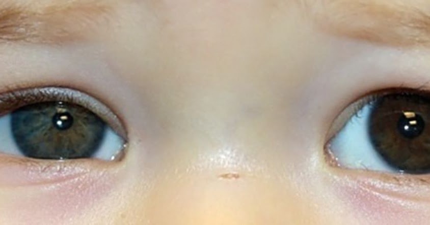 Stromme Syndrome Images, Meaning, Symptoms, Causes, Treatment - Health ...