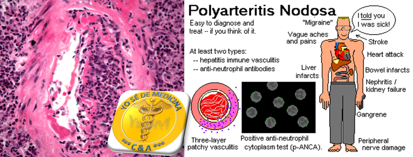 Poliarteritis Nudosa; Poliarteritis Esencial; Arteritis Necrotizante ...