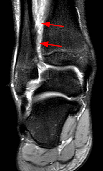 MRI Musculo-Skeletal Section: High ankle sprains.