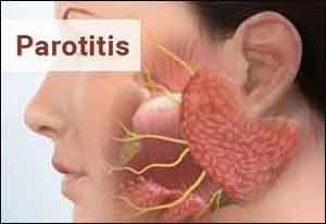 Parotitis Adalah Gangguan Sistem Pencernaan Yang Disebabkan ...