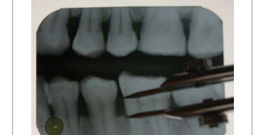 Comparision between Conventional Radiography (IOPA) and Digital Radiography