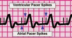 AV Sequential (Dual Chamber) Pacemaker ~ Nursing