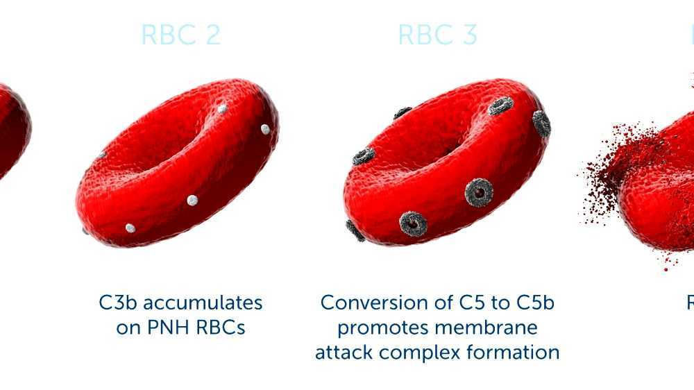 Paroxysmal nocturnal hemoglobinuria