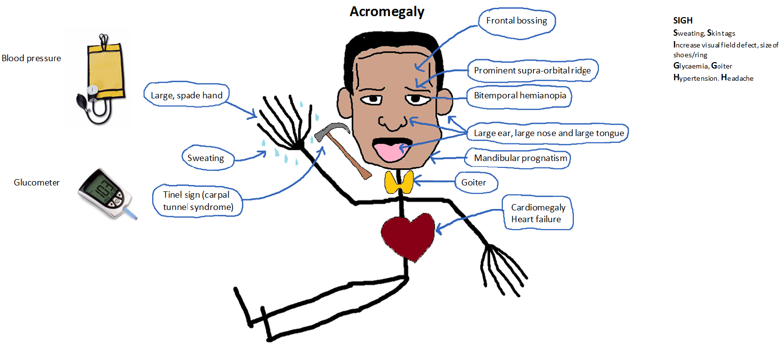 OurMedicalNotes: Acromegaly