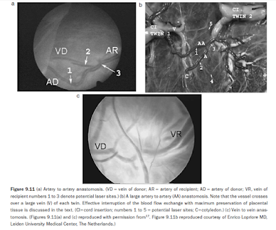 Selective laser | Twin-Twin Transfusion Syndrome (TTTS)