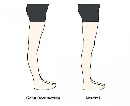 REEDUCACIÓN POSTURAL Y DE MOVIMIENTO : SÍNDROME DE HIEPERLAXITUD/ GENU ...