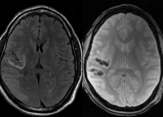 Dr Balaji Anvekar FRCR: Role of T2*GRE