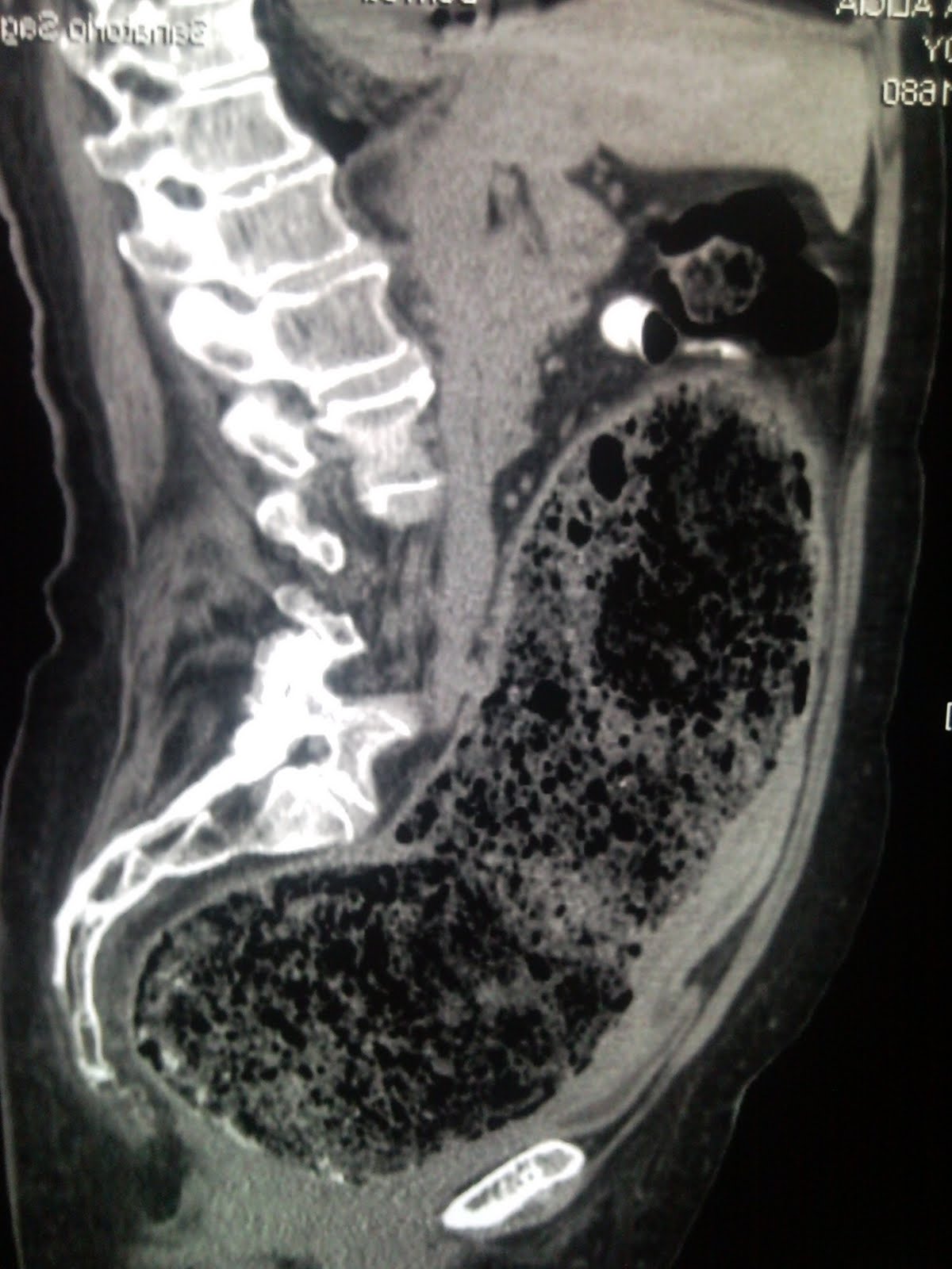 MEDICINA INTERNA Argentina: FECALOMA