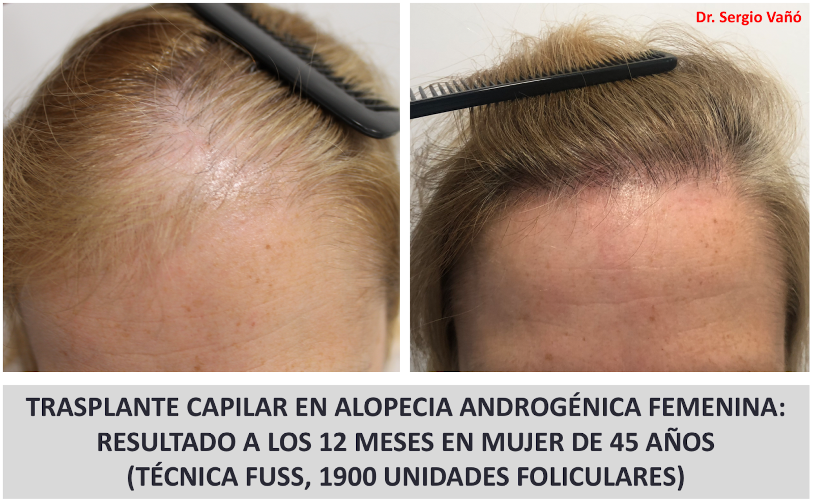 Dermatología-Madrid: INJERTO CAPILAR EN MUJERES