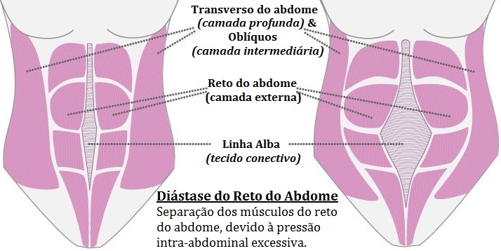 Limatreinamento: Diástase do Reto Abdominal