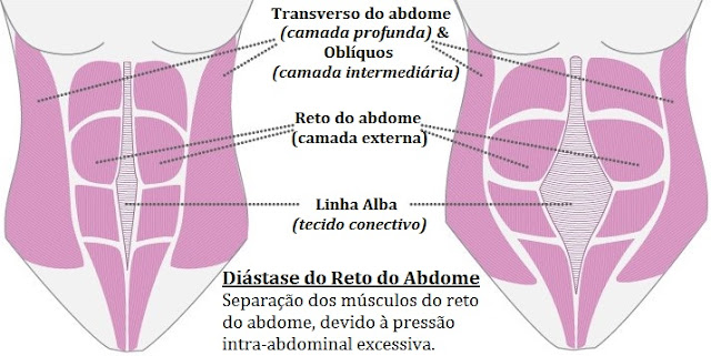 Limatreinamento: Diástase do Reto Abdominal