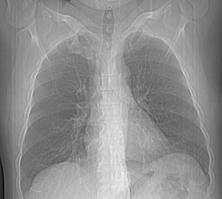 Miliary TB-HRCT - Sumer's Radiology Blog