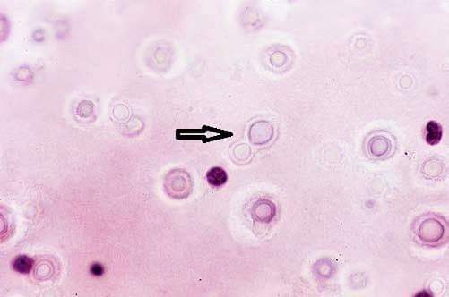 Cryptococcal meningitis