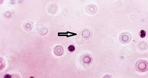 Cryptococcal meningitis
