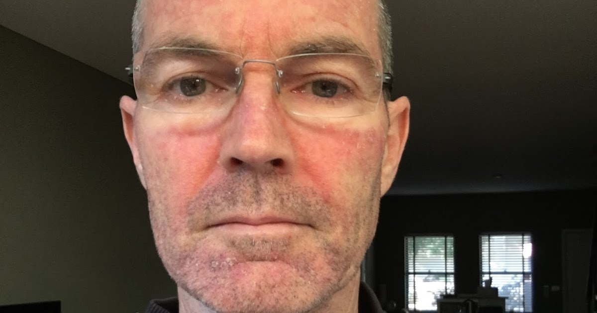 Efudix Treatment: Day 30 - Post day 10