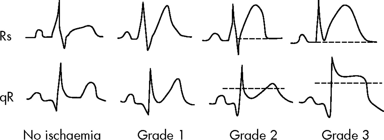 Asuhan Keperawatan Jamz-Vie: BELAJAR EKG yukk...