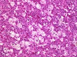 Medical Treatment Pictures-for Better Understanding: Idiopathic ...