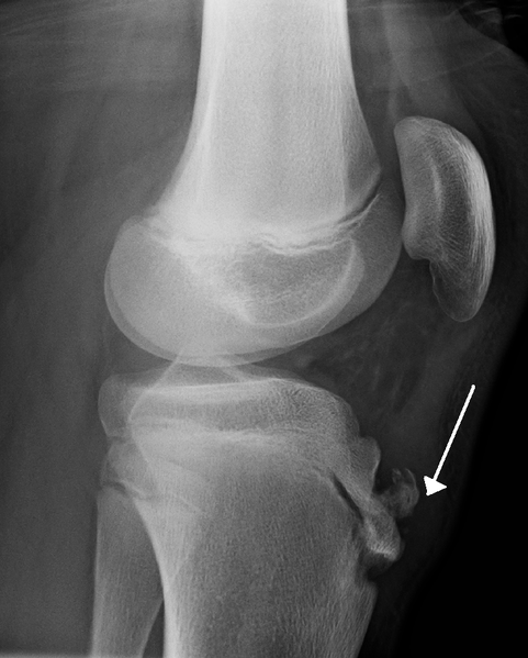 ON - RADIOLOGY: X-ray Osgood-Schlatter disease