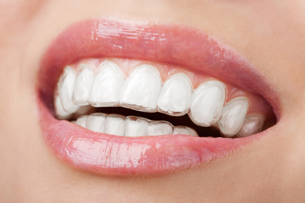 Civil Gentle Dental Care: What Is So Fascinating About Invisalign Canberra?