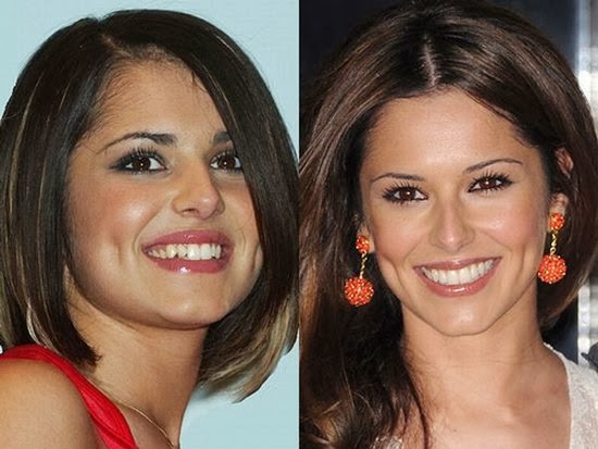 Cheryl Cole Plastic Surgery