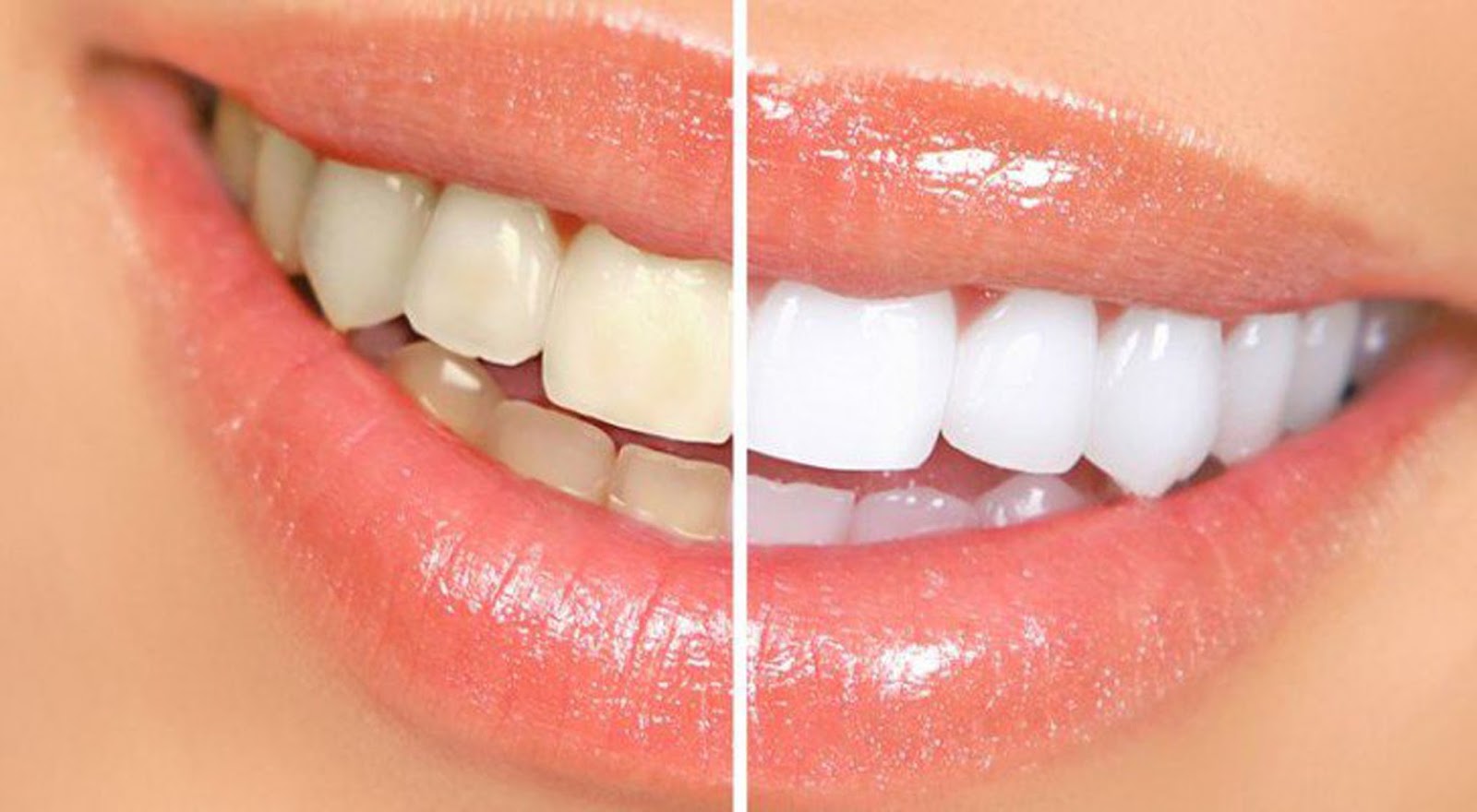 Home Remedies For Yellow Teeth The Discover Reality