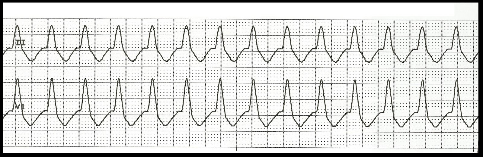 Basic ECG Rhythm Test 03