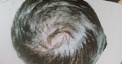 Cradle Cap on Baby's Scalp; What Causes It and How to Treat it ...