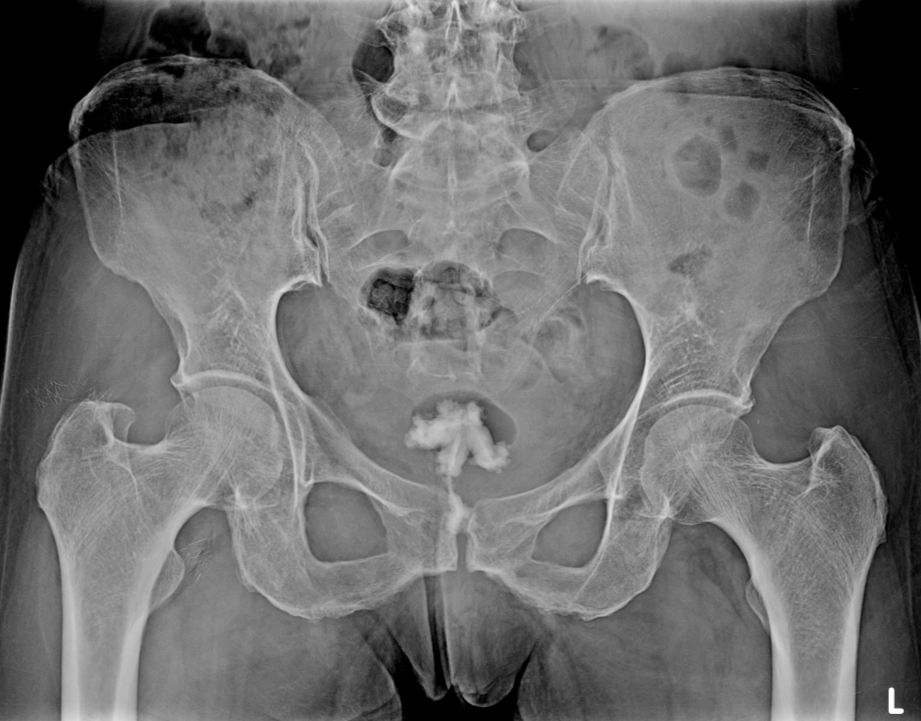 Encrusted IUCD-Plain Film - Sumer's Radiology Blog