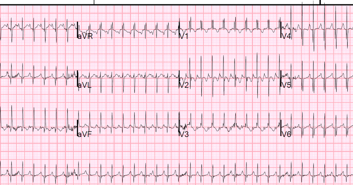 Dr. Smith's ECG Blog: A very fast narrow complex tachycardia in an Infant
