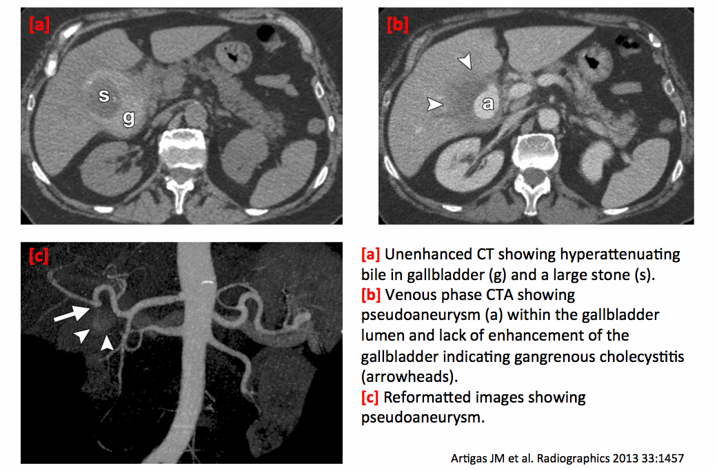CT Angiogram for evaluation of severe hematochezia