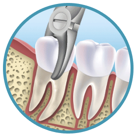 Free Online Dental Consultation: Tooth Extraction