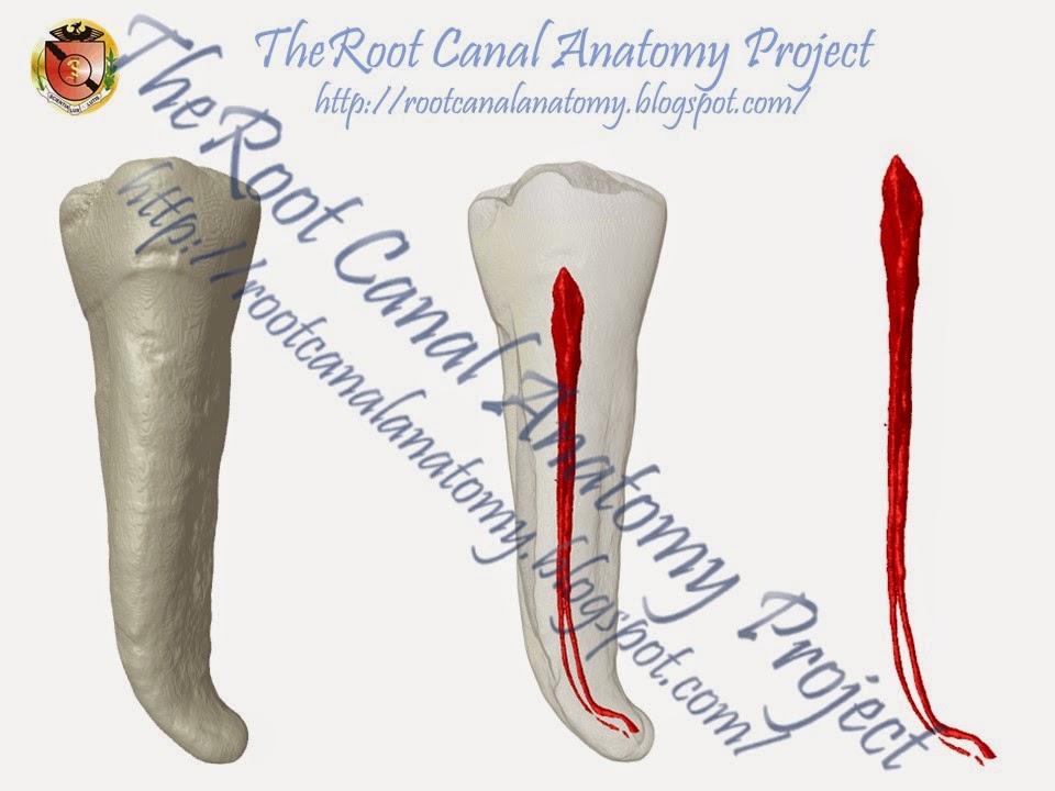 The Root Canal Anatomy Project: Mandibular First Premolar: Two Root Canals