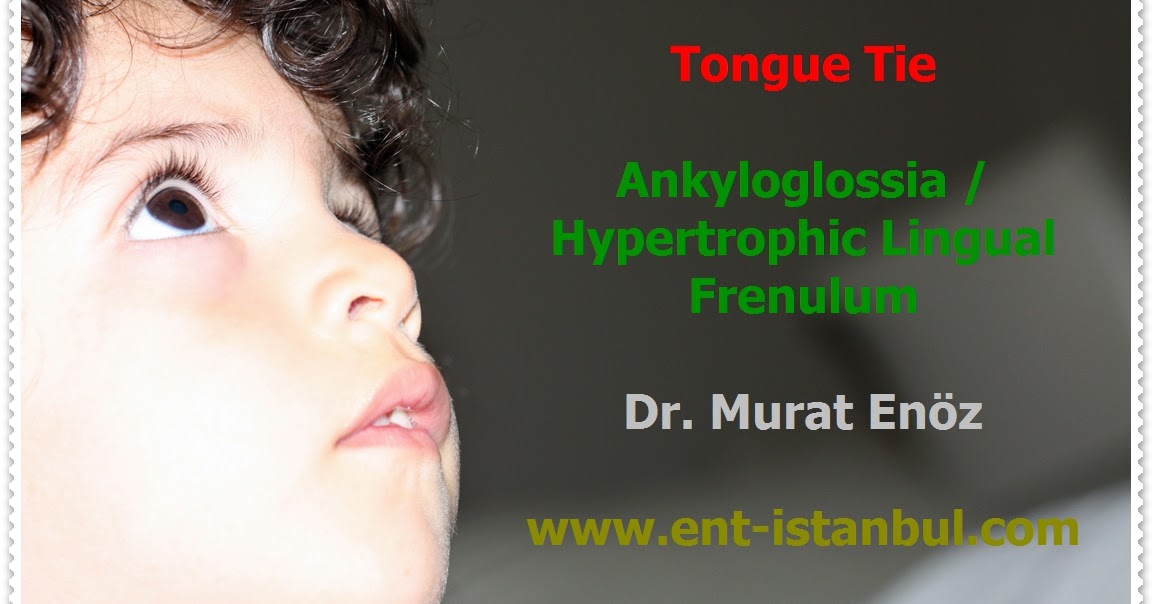 Tongue Tie (Ankyloglossia) - Definition, Symptoms, Diagnosis and Treatment
