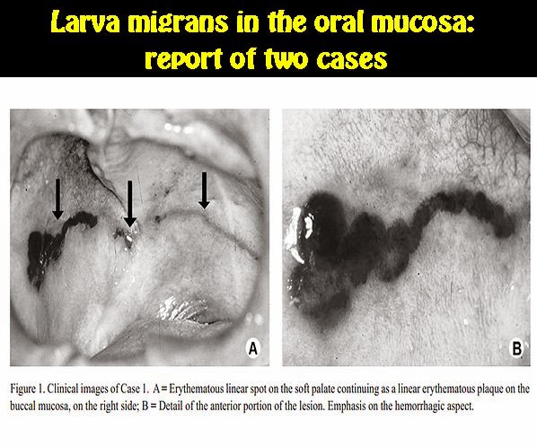 PDF: Larva migrans in the oral mucosa: report of two cases - Ovi Dental