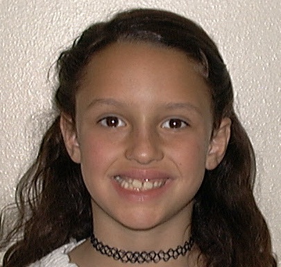 Truman Orthodontics: Unilateral Crossbite With a Functional Shift