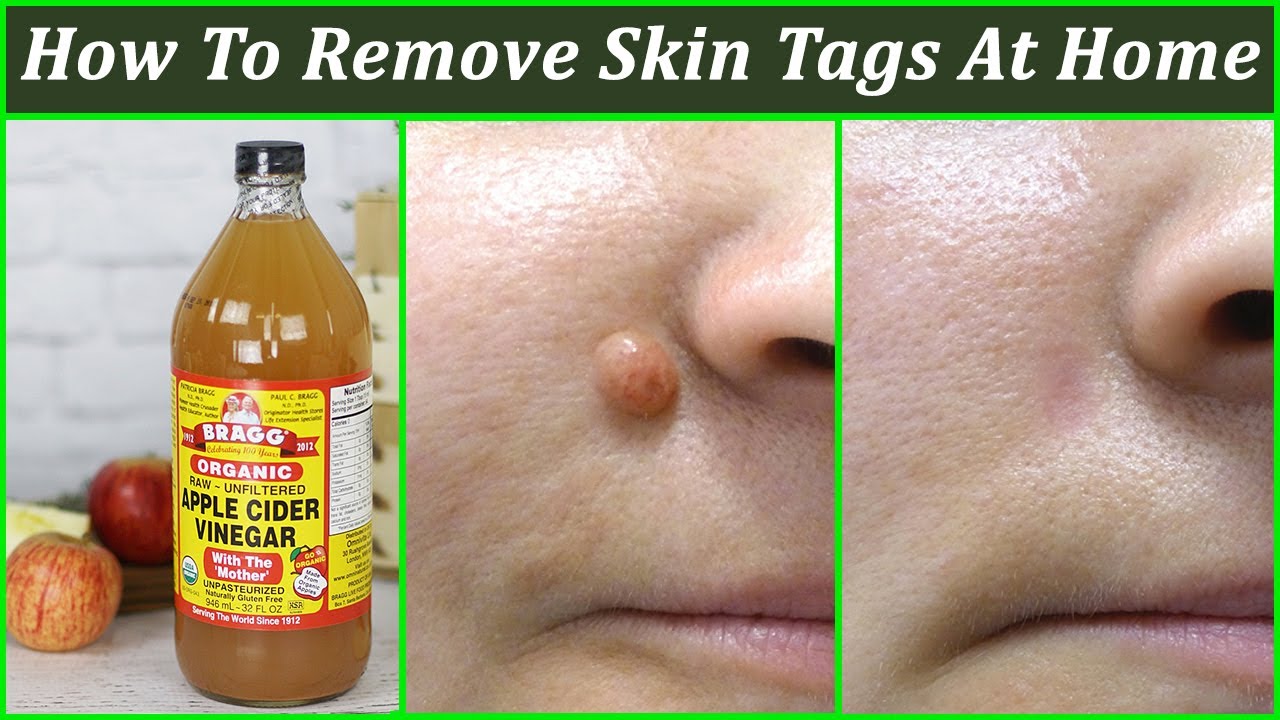 7 easy and homemade ways to remove skin tags without going to a doctor ...