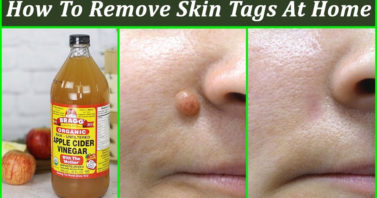 7 easy and homemade ways to remove skin tags without going to a doctor ...