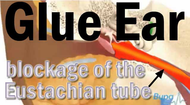 Glue Ear Best Treatments Control And Cure Your