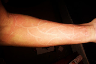 Allergic Reaction Face Rash Pictures : Hives - Understanding This ...