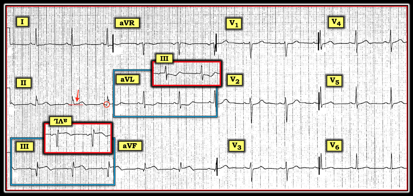 ECG Interpretation: ECG Blog #158 (STEMI – OMI – Ischemia – ST ...
