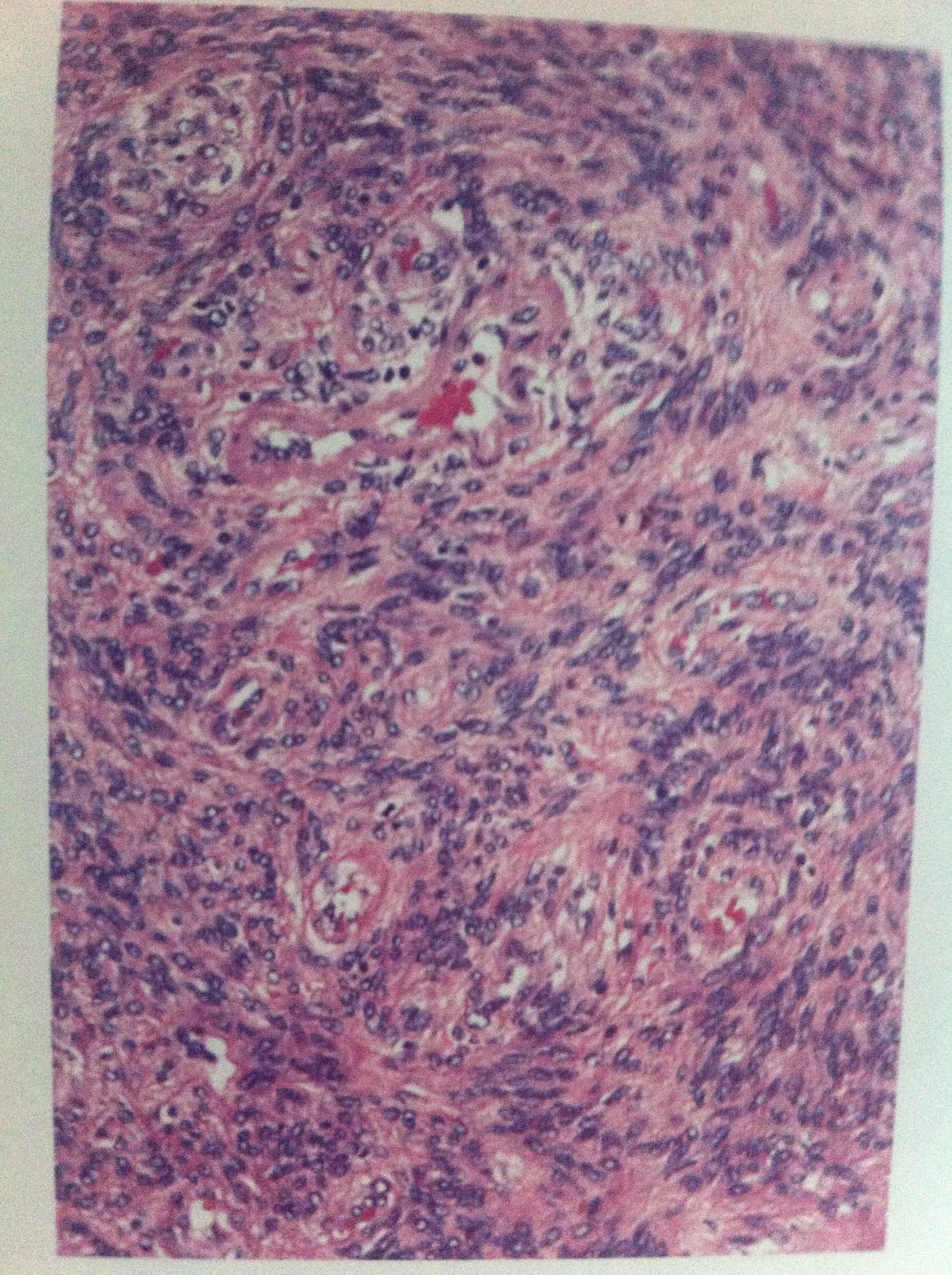 Pathology: CELLULAR ANGİOFİBROMA